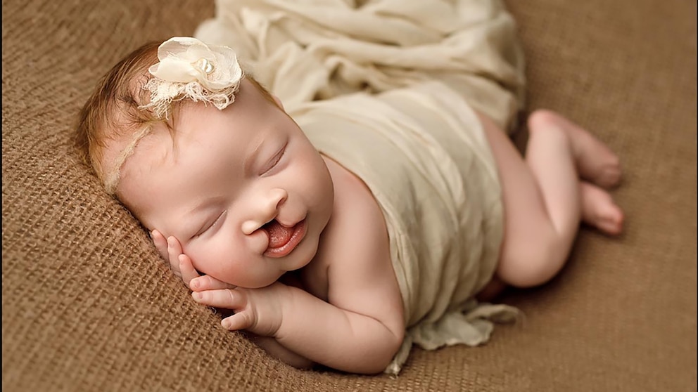 Parents open up after photo of their baby with cleft lip and palate ...