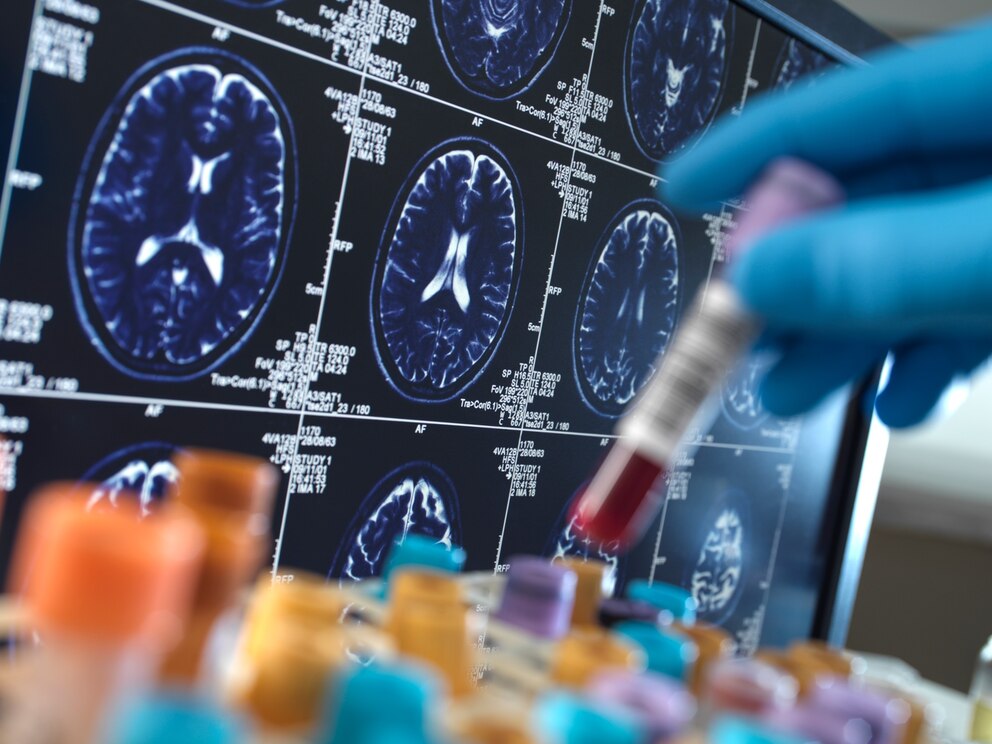 Alzheimer's Association calls on doctors to use newer early diagnostic ...