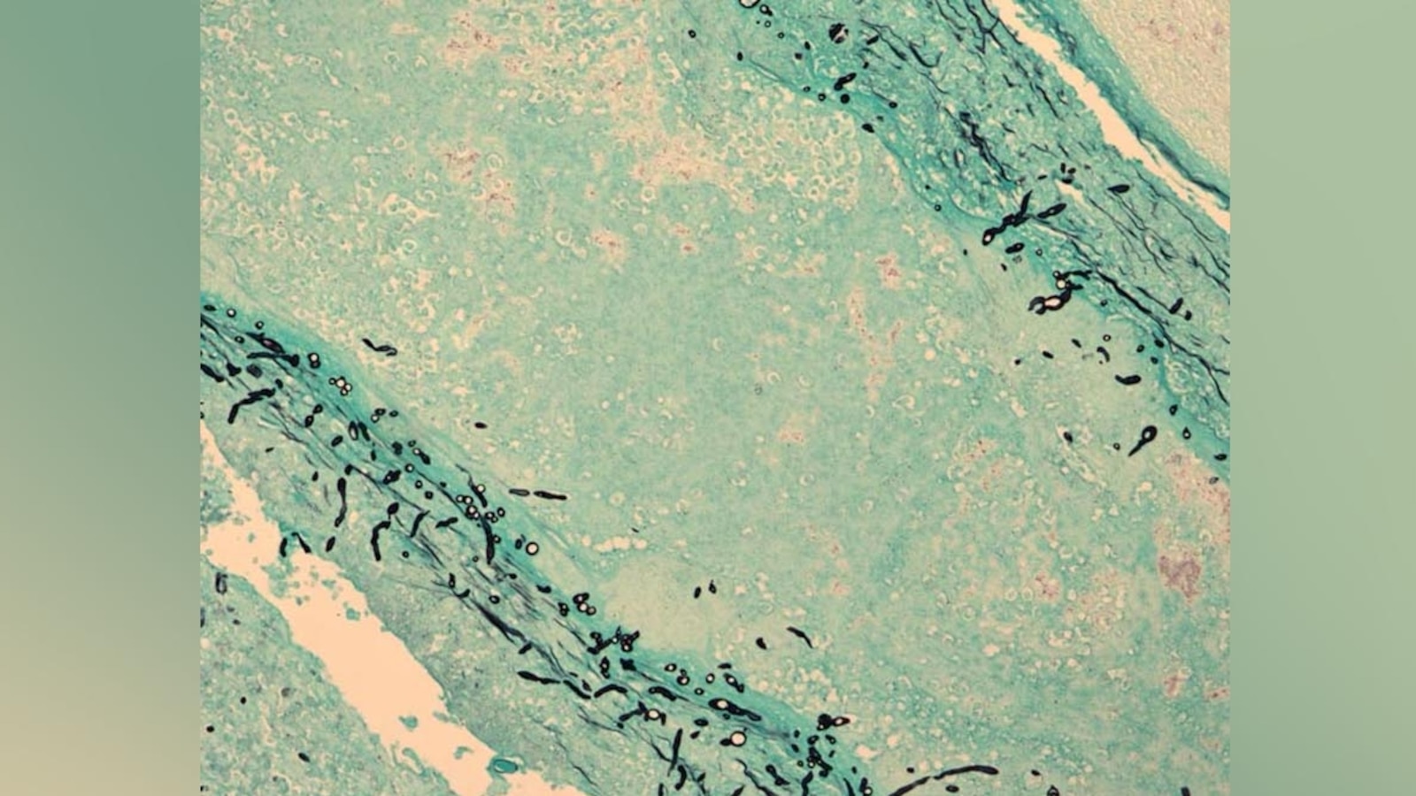 What is fungal meningitis after 2 Americans die from the infection ...