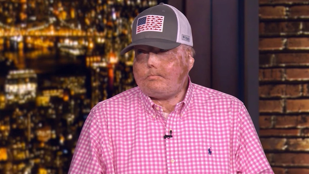 Video Face transplant recipient Pat Hardison reflects on struggles in ...