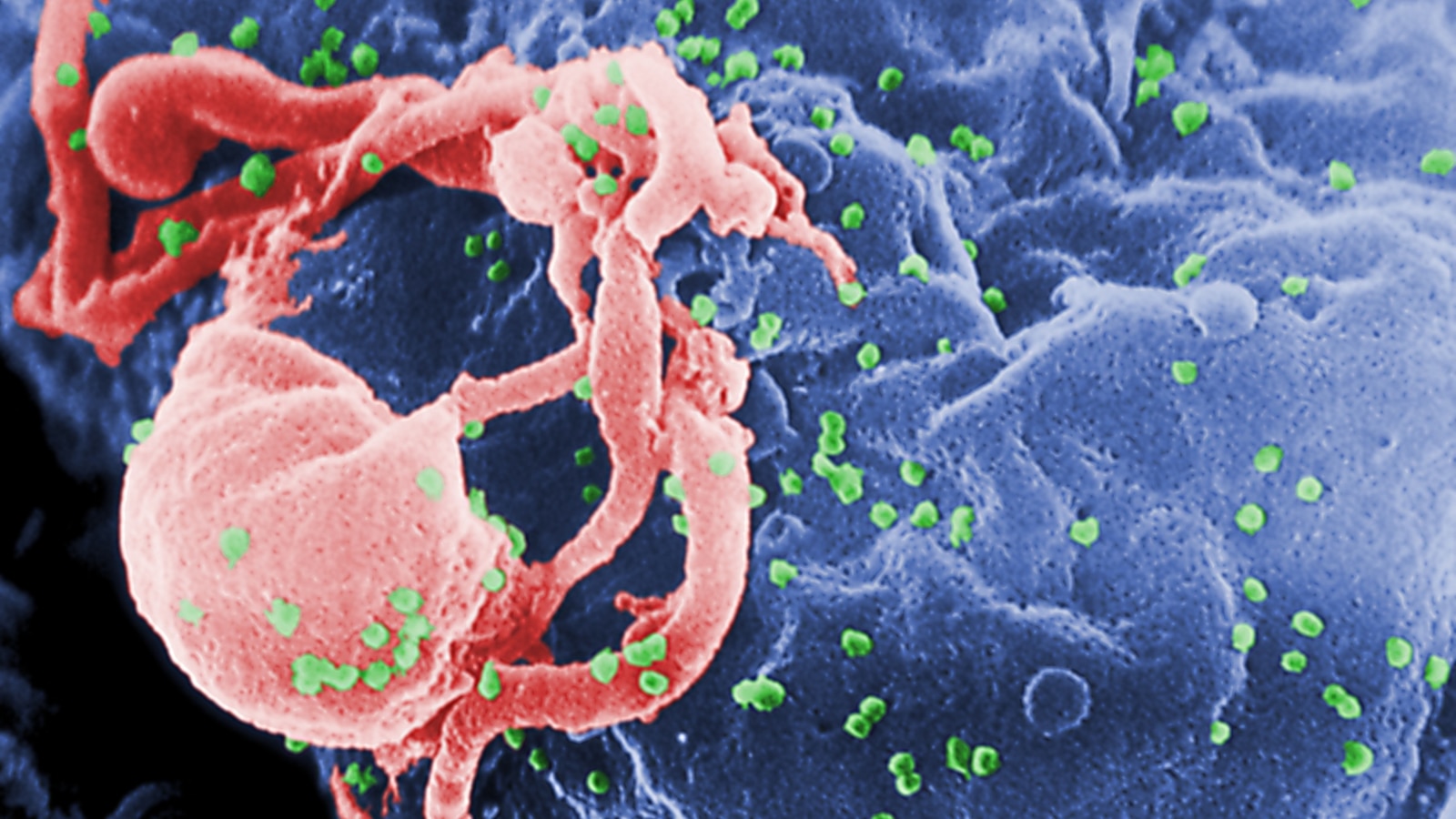 4 children surpass a year of HIV remission after treatment pause: Study ...