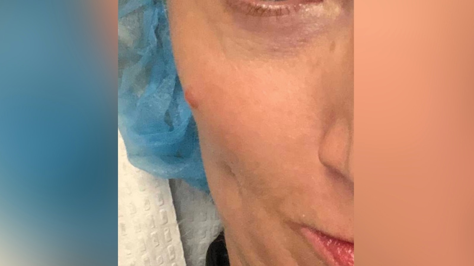 Woman shares warning after mark on face diagnosed as cancerous tumor 2 ...