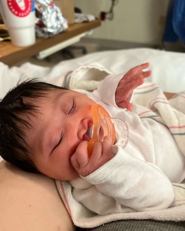 Stillborn Fetus Attached To Head