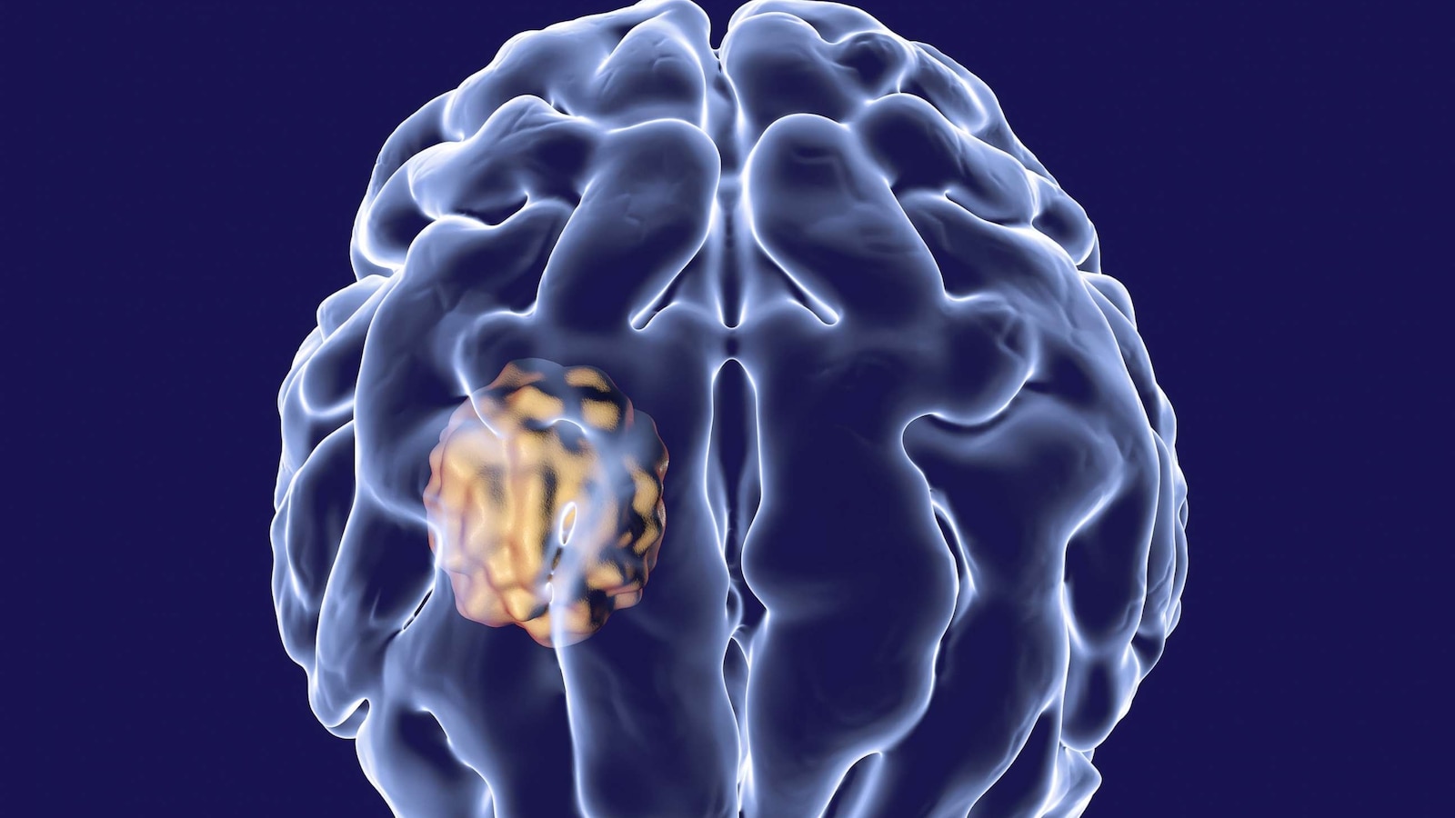 Nevada reports cluster of rare brain infection in children in 2022 ...