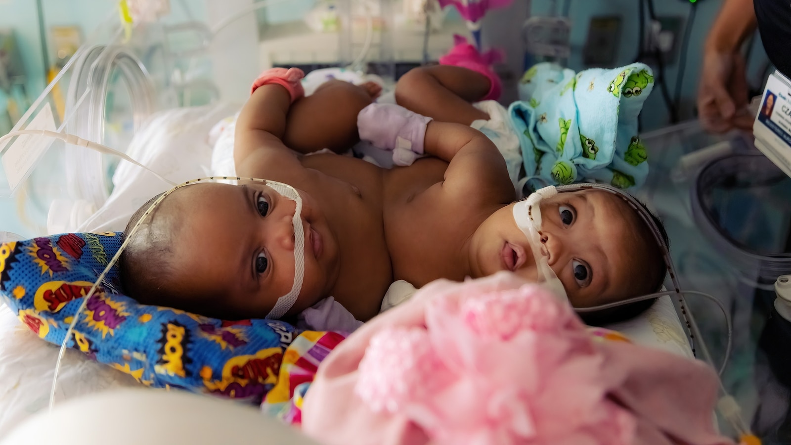 Family of formerly conjoined twins say they're 'doing great' 1 year ...